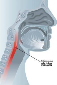Come curare la faringite: cause e rimedi - Terapia 2