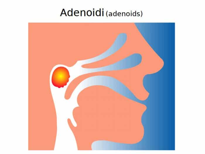 Come curare le adenoidi nei bambini | Terapia 2